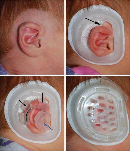 EarWell Centers of Excellence - DFWChild